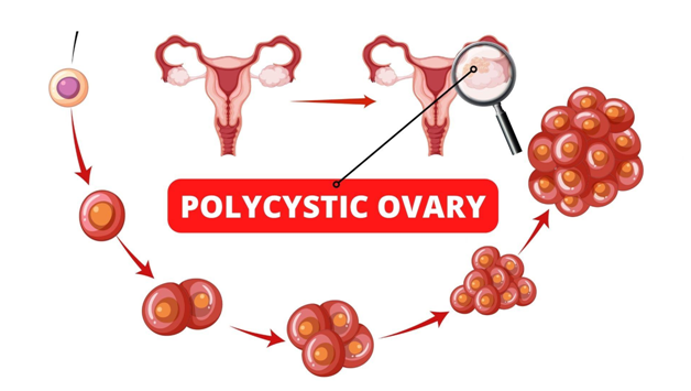 Polycystic Ovary Syndrome Diagram Polycystic Ovarian Syndrome (PCOS)